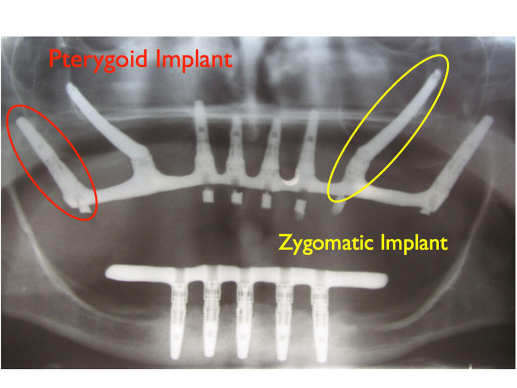 Zygomatic and Pterygoid Implants - Temecula Dental Implants